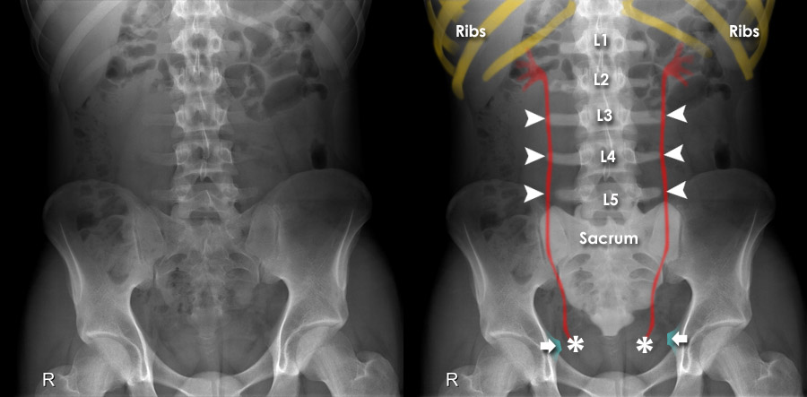 Sacrum Anatomy Xray