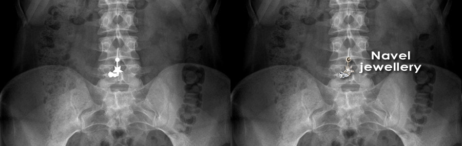 Calcification In The Veins