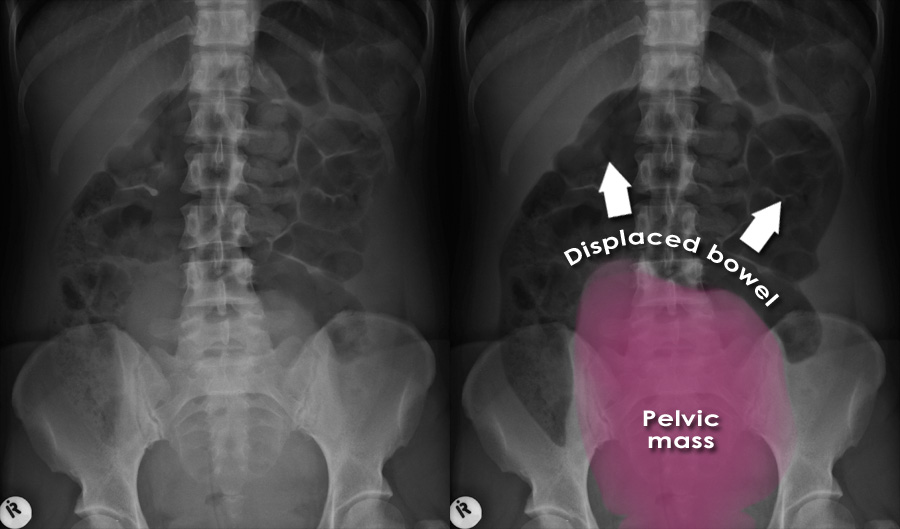 Pelvic Tumor