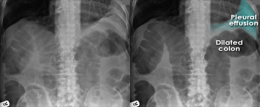 Abdominal X-ray - Abnormal soft tissues and bones - Lung bases