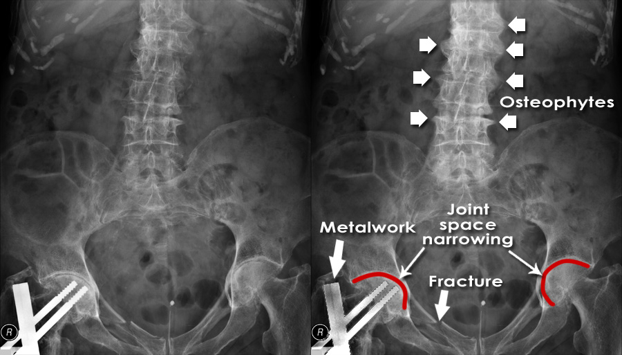 Osteoarthritis Spine X Ray