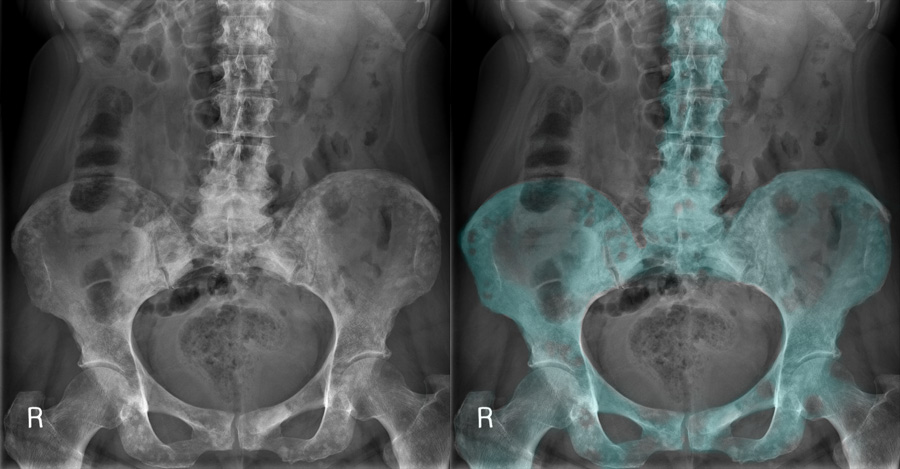 Lumbar Spine Xray Abnormal
