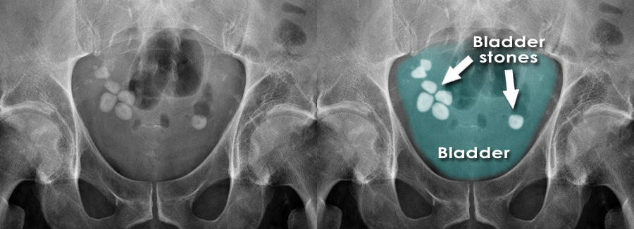 Abdominal X Ray Abnormal Calcification Bladder Stones