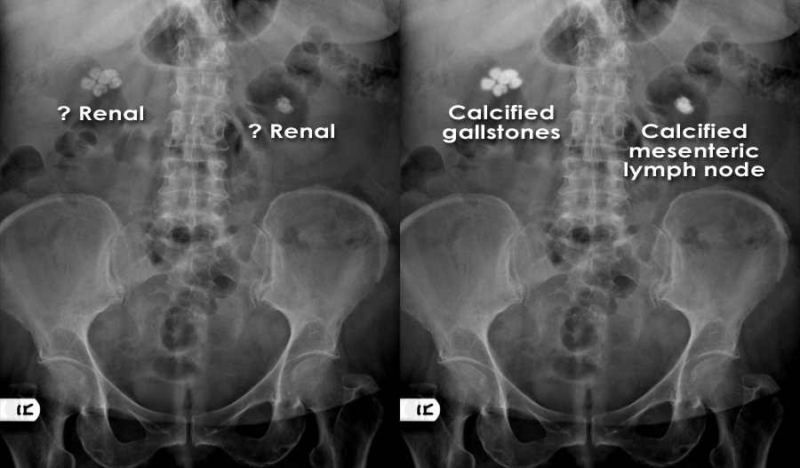Nephrolithiasis X Ray