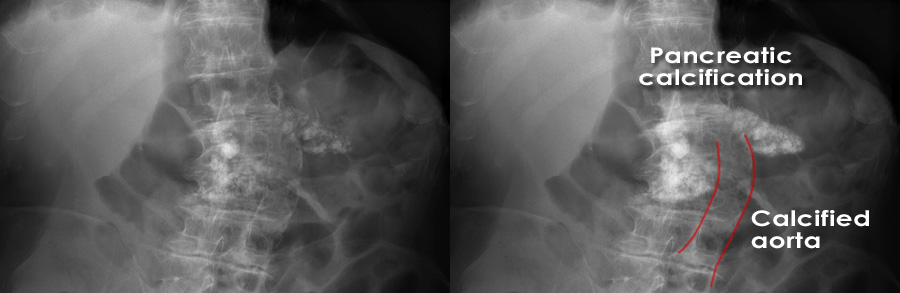 Abdominal X-ray - Abnormal calcification - Retroperitoneal calcification
