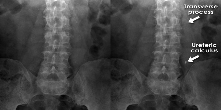 Abdominal X Ray Abnormal Calcification Ureteric Calcification