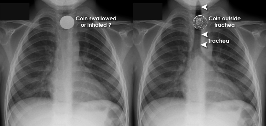 Abdominal X-ray - Artifacts - Ingested blunt object