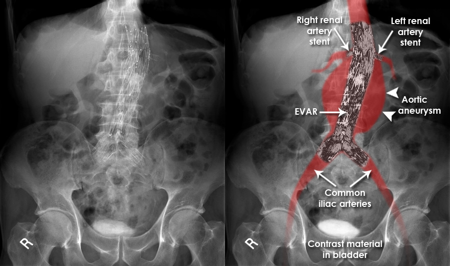 Abdominal X ray Artifacts Endo Vascular Aneurysm Repair EVAR abdominal-x-ray-artifacts-endo-vascular-aneurysm-repair-evar