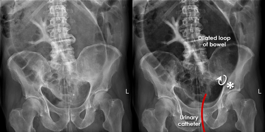 Volvulus X Ray Omega Sign