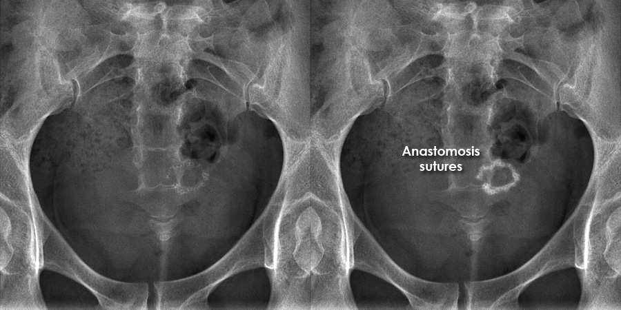 Abdominal X-ray - Artifacts - Anastomosis sutures
