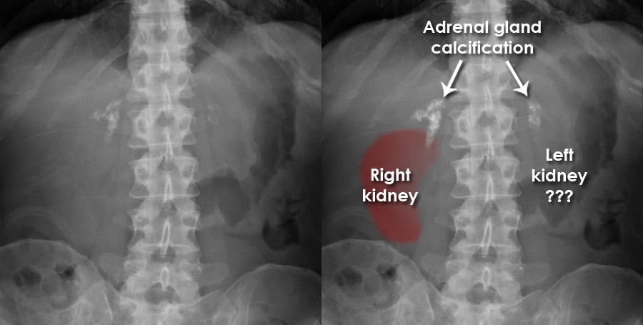 Abdominal X-ray Gallery - Calcification - Adrenal calcification