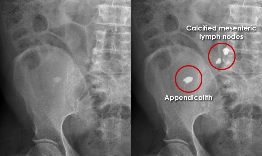 Abdominal X-ray Gallery - Calcification - Appendicolith