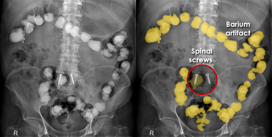 Barium X Ray Abnormalities