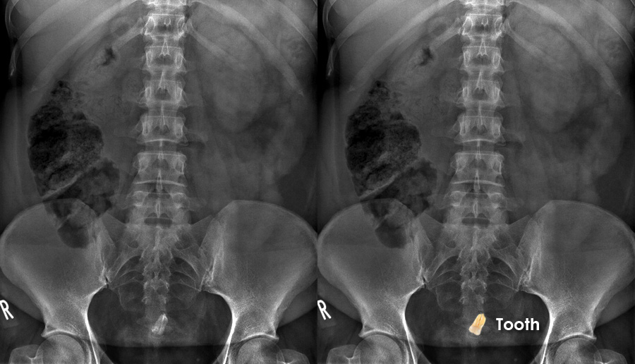 Psoas Sign X Ray