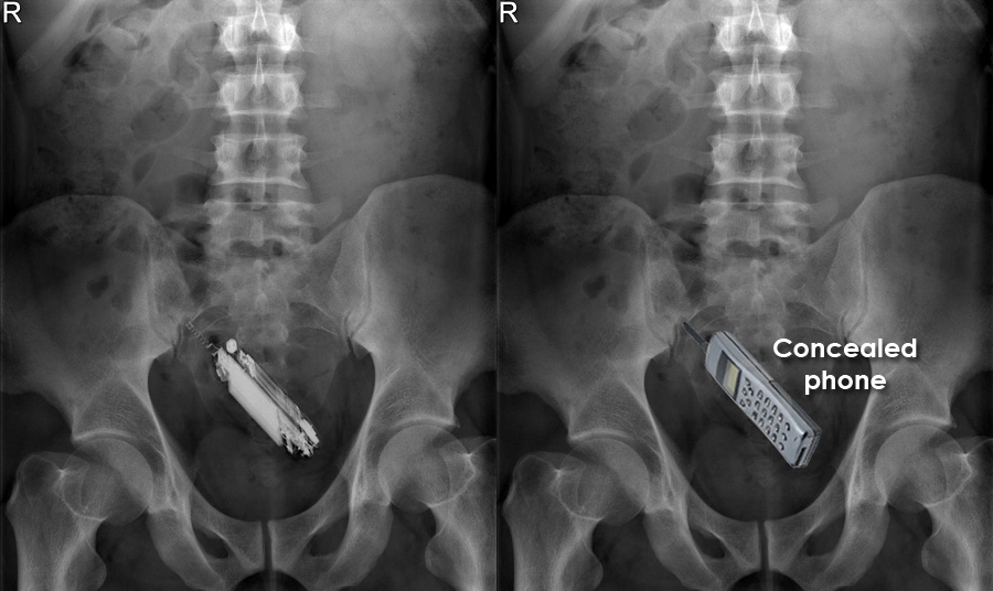 Abdominal X-ray - Artifacts - Rectal artifact
