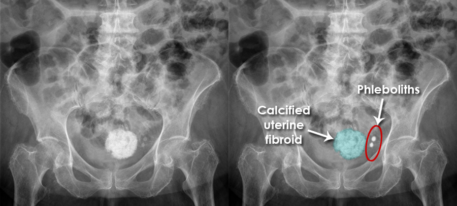 Uterine Fibroids Xray Uterine Fibroid An Overview | ScienceDirect