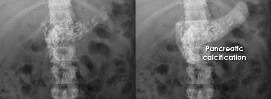 Abdominal X-ray Gallery - Calcification - Pancreatic calcification
