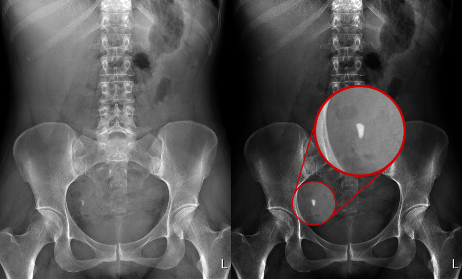 Kidney Stones Kub Xray