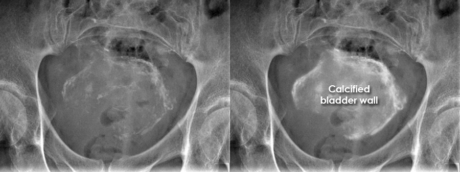 Abdominal X Ray Gallery Calcification Bladder Wall Calcification