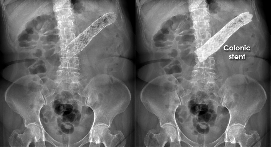 Abdominal X-ray - Artifacts - Colonic stent