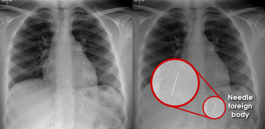 Abdominal X-ray - Artifacts - Ingested sharp objects