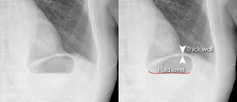 Normal Abdominal Xray Large Bowel Gas Image