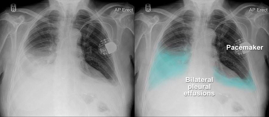 Costophrenic Angle Pleural Effusion