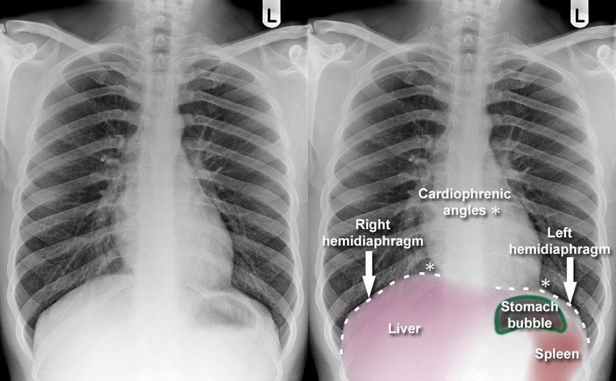 Chest X-ray Anatomy - Diaphragm