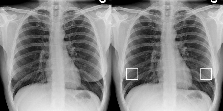 Normal Chest Xray Labeled