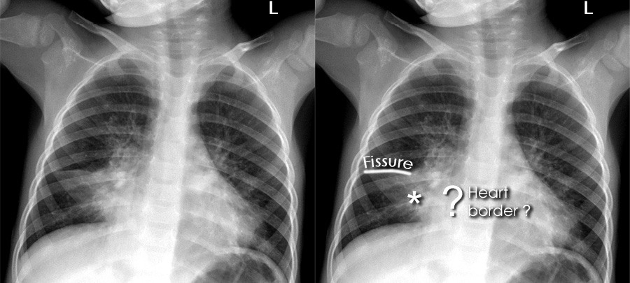 Chest X Ray Anatomy Lung Lobes And Fissures In The Ri
