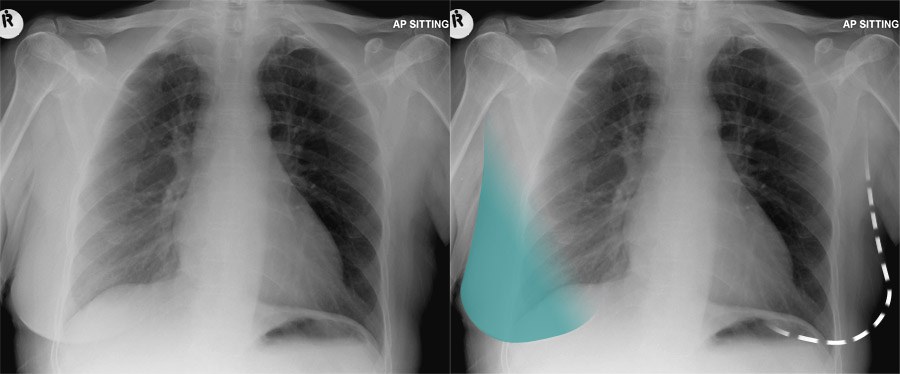 Chest X Ray Abnormality Classification Using Monk Ai - vrogue.co Chest X Ray Abnormality Classification Using Monk Ai - vrogue.co