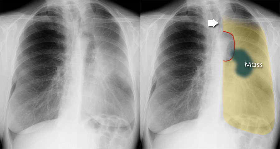 Chest X-ray - Airways and lung collapse - Left upper lobe collapse