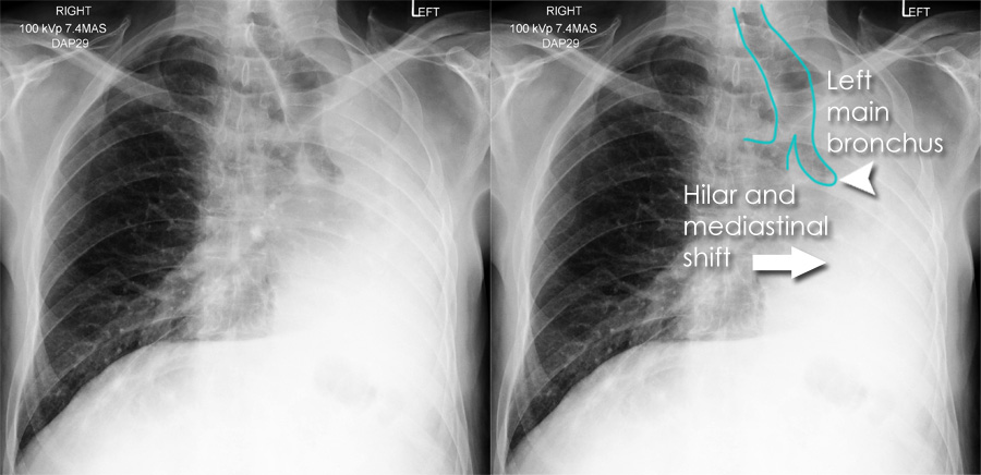 Chest X-ray - Airways and lung collapse - Pneumonectomy