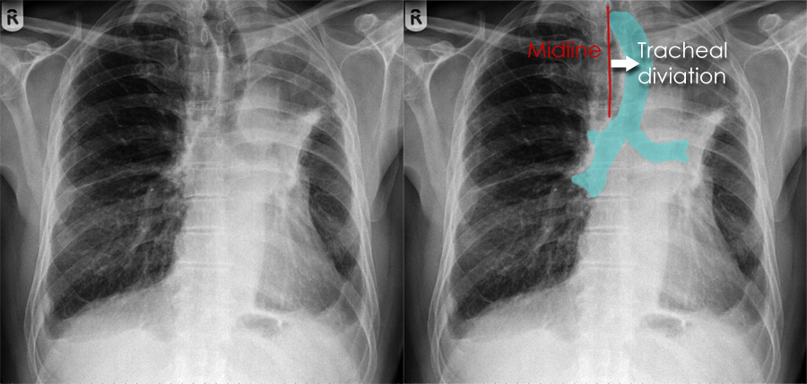 Chest X-ray - Airways and lung collapse - Radiation fibrosis