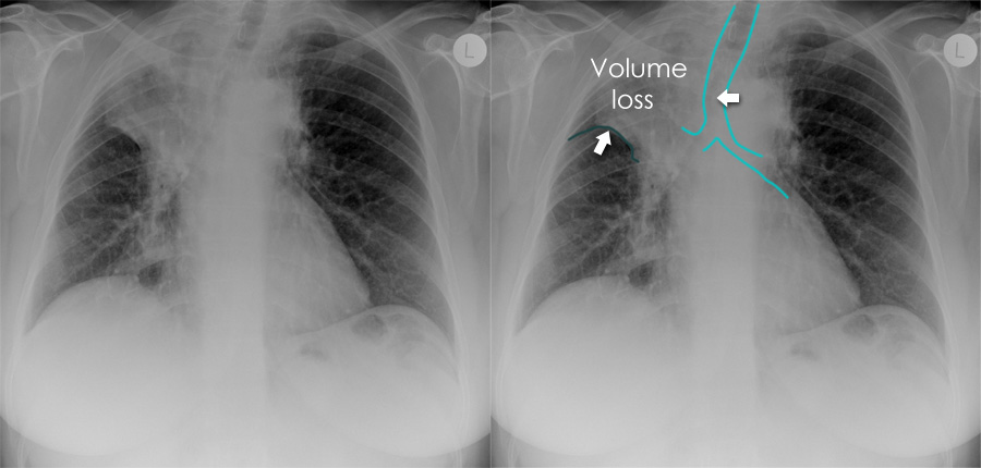 Lung Collapse Chest X Ray
