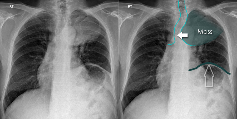 Phrenic Nerve Imaging Radiology Key - vrogue.co