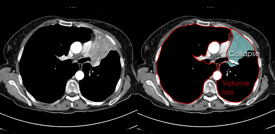 Chest X-ray - Airways and lung collapse - Left upper lobe collapse CT