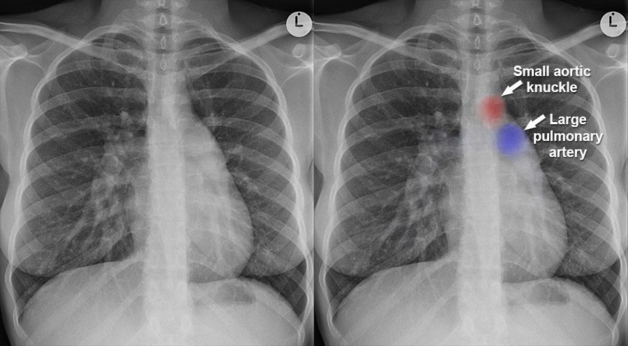 Chest X Ray Cardiac Disease Congenital Heart Disease