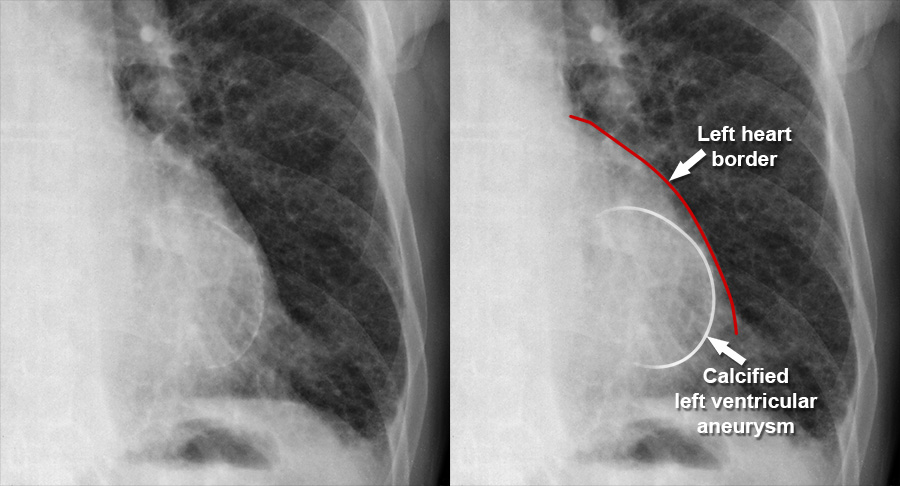 Figure 1 From Chest X Ray Cardiac Anatomy And Patholo