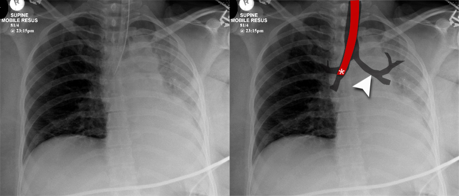 Chest X-ray - Devices and artifacts - Misplaced endotracheal tube