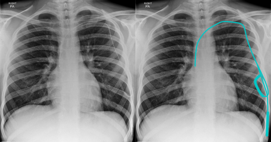 Chest X-ray - Devices and artifacts - Tunnelled line