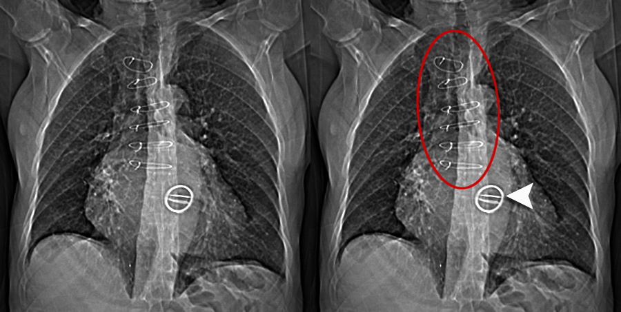 Heart Valve Replacement Xray Heart Valve Replacement Xray