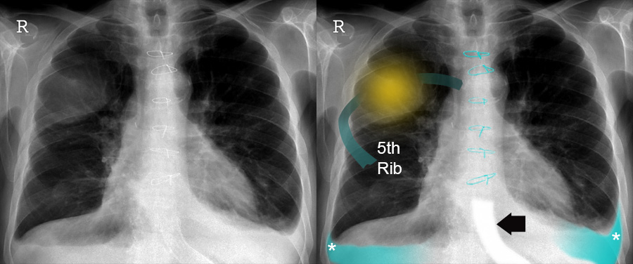 Chest X-ray - Devices and artifacts - Oesophageal stent