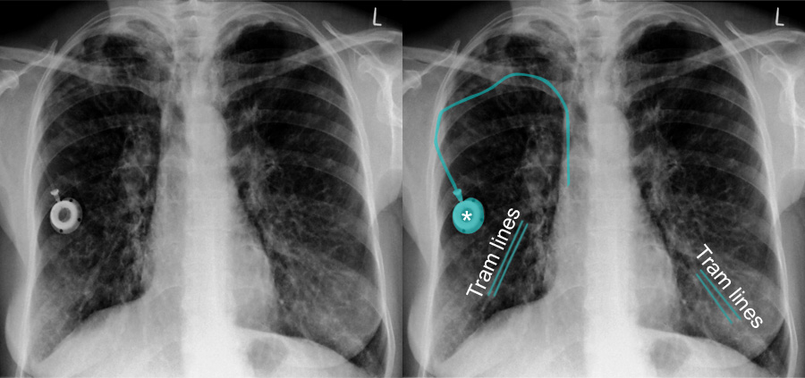 Bronchiectasis X Ray Tram Track