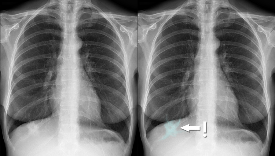Chest X-ray - Lung cancer - Common pitfall 2