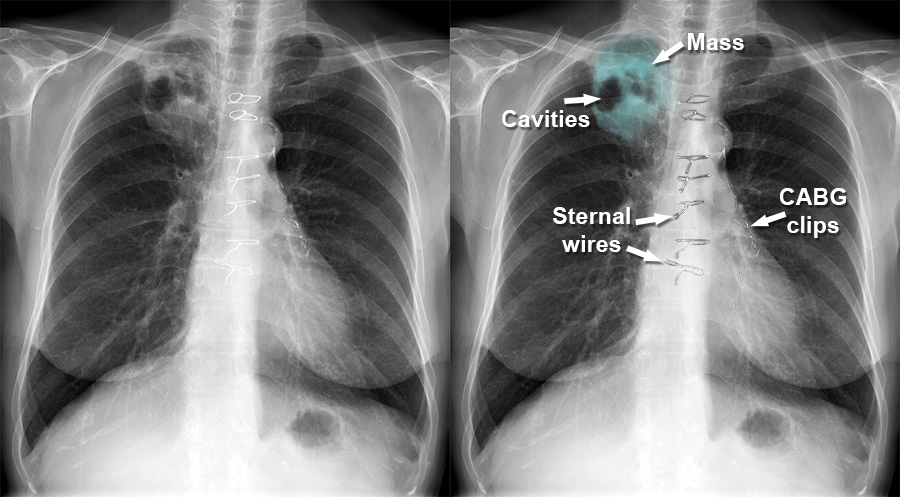 Skin Cancer Chest X Ray How To Interpret A Chest X Ra - vrogue.co Skin Cancer Chest X Ray How To Interpret A Chest X Ra - vrogue.co