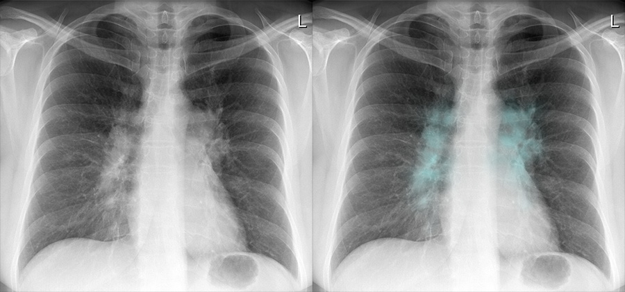 Chest Xray Shows A Welldefined Opacity In The Left Hilar