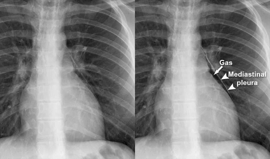 Emphysema Chest X Ray Nbkomputer