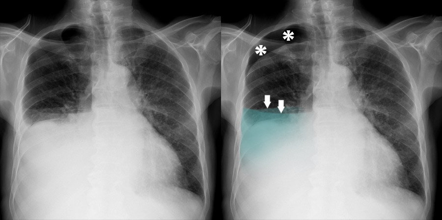Chest X-ray - Pneumothorax gallery - Iatrogenic pneumothorax