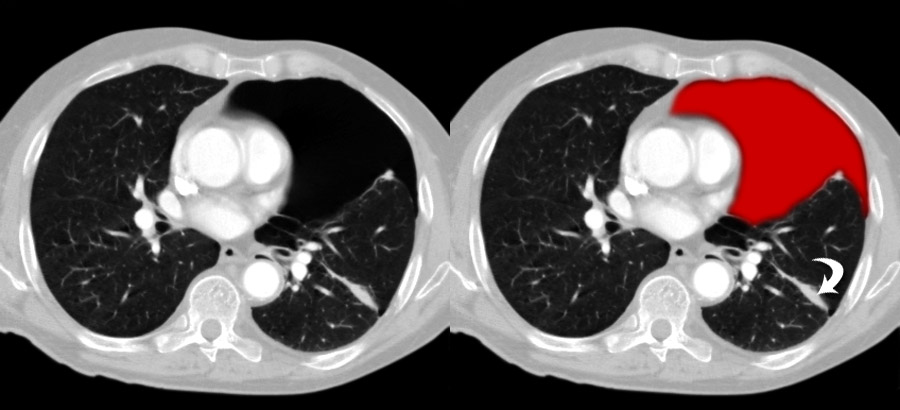 Chest Xray Pneumothorax Radrounds Radiology Network